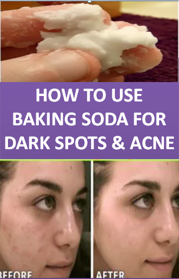 HOW TO USE BAKING SODA FOR DARK SPOTS & ACNE SCARS - TOP 5 DIY