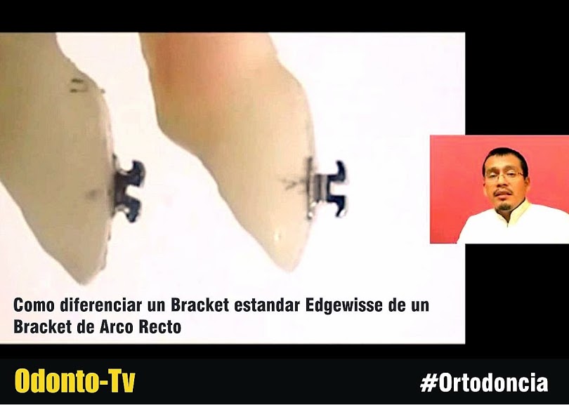 BRACKETS: Como diferenciar un bracket estandar Edgewisse de un bracket ...