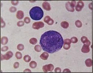 Células importantes en hematología: LEUCEMIA MIELOIDE AGUDA M3 ...
