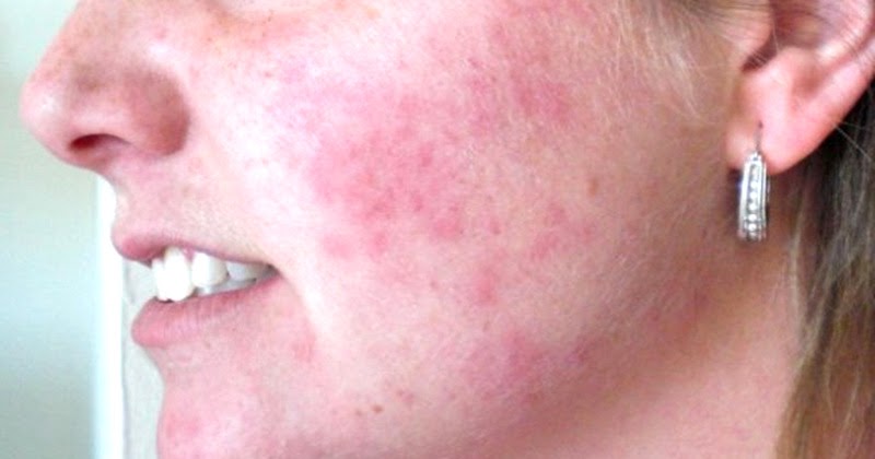 Παγκόσμια Ημέρα για τον Συστηματικό Ερυθηματώδη Λύκο (ΣΕΛ) | MEDLABNEWS ...