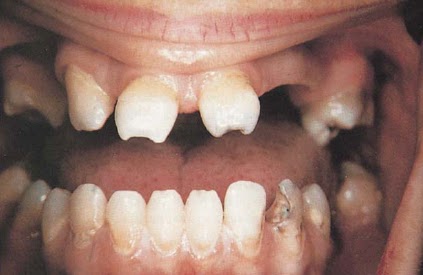 Rx Pics: HUTCHINSON INCISORS : iN CONGENITAL SYPHILIS
