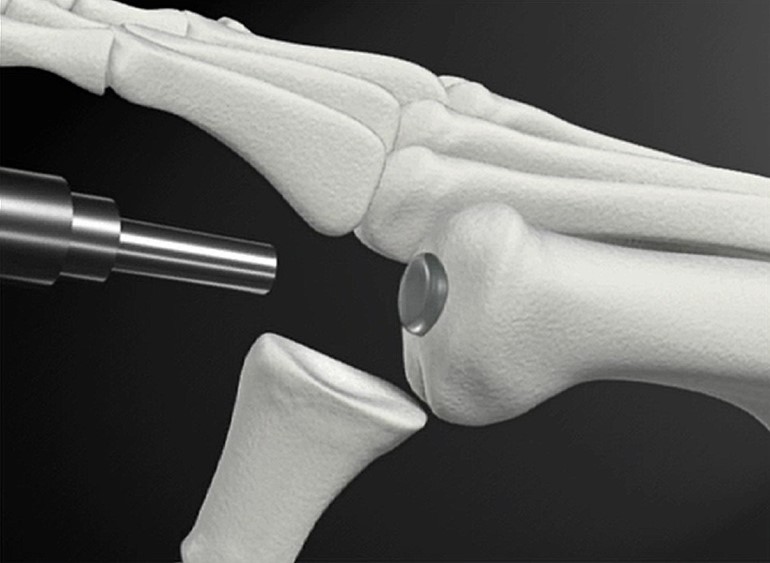 Global Medtech: FDA Approved Cartiva Synthetic Cartilage Implant