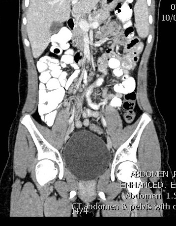 Dr.OBSERVER: Suprapubic Abdominal Pain