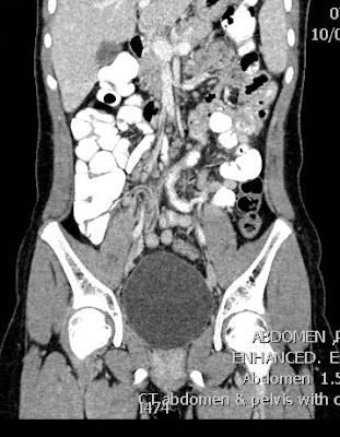 Dr.OBSERVER: Suprapubic Abdominal Pain