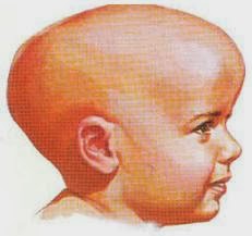 Enfermería del Mundo: Hidrocefalia