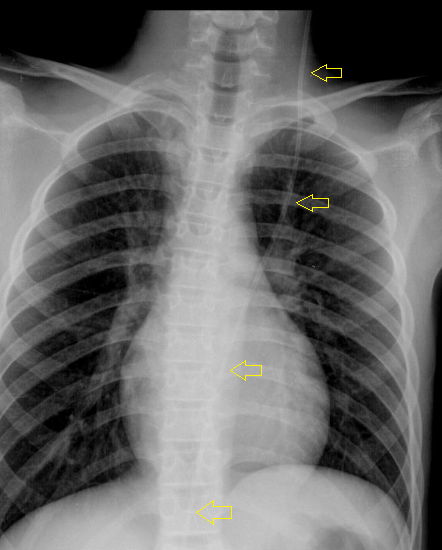 El Baúl Radiológico: VÁLVULAS DE DERIVACIÓN VENTRÍCULO-PERITONEAL ...