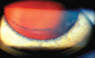 GLAUCOMA SPECIALIST BLOG: "THE GLOG": PIGMENTARY GLAUCOMA