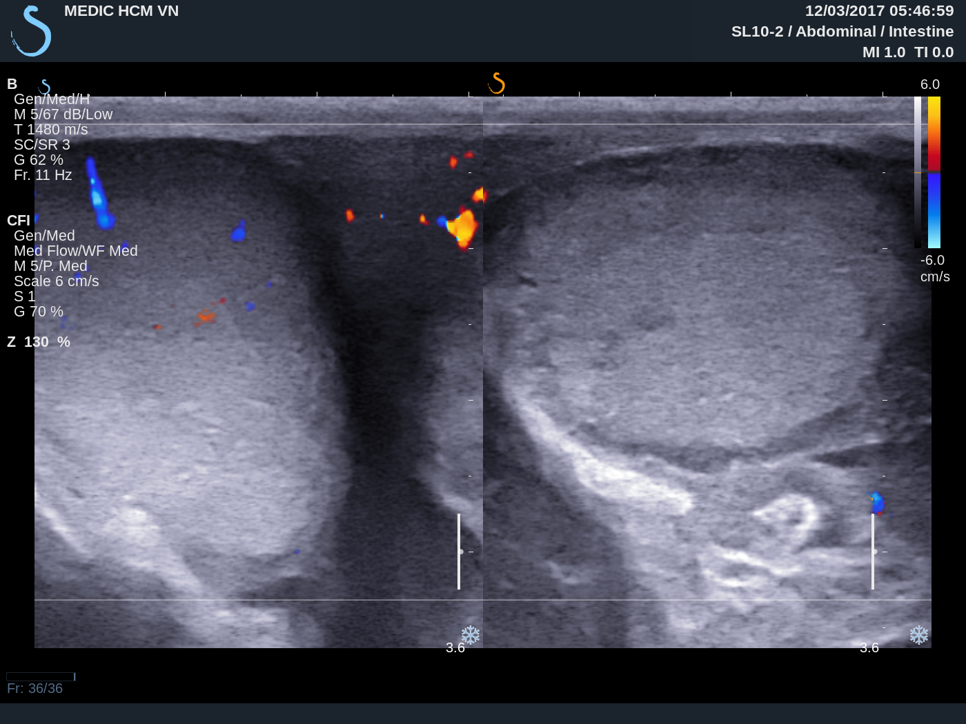 Vietnamese Medic Ultrasound Case 422 Testis Torsion Dr Phan Thanh HẢi Medic Medical Center