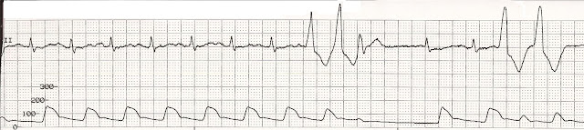 Float Nurse: Multiple PVCs