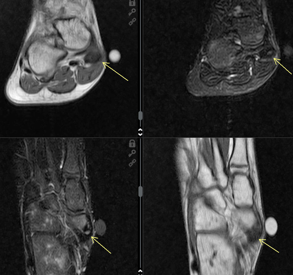 OCAD Tester Blog: Symptomatic accessory navicular in a 9 year old child?