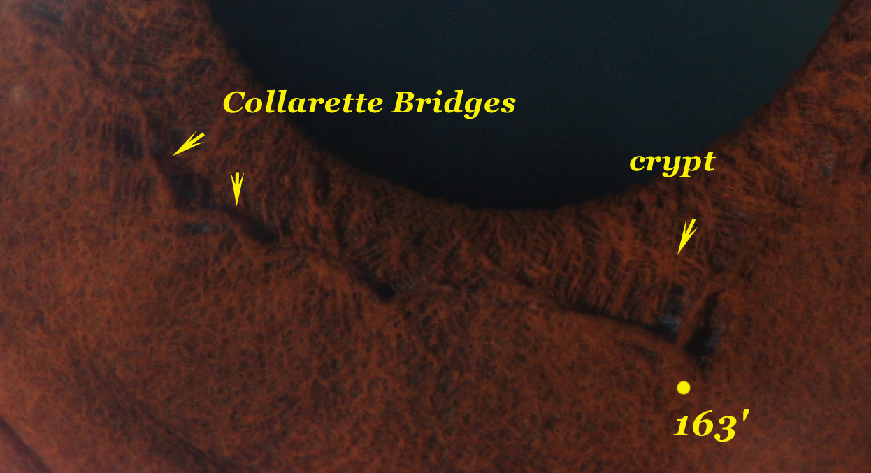 Modern & Multidimensional Iridology: Collarette Bridges & Kreb's Cycle ...