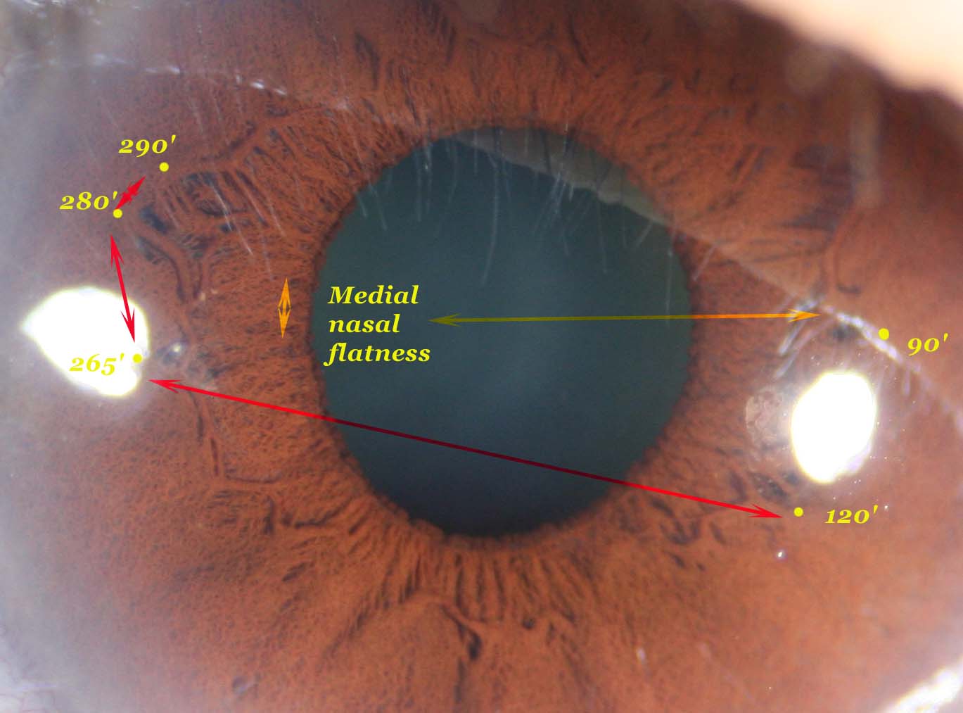Modern & Multidimensional Iridology: The Correlation of Iris Signs ...