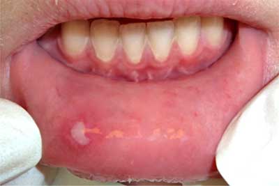 Study Medical Photos: Description Of Mouth Ulcers With Pictures For ...