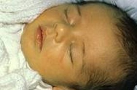 Haemolytic Disease of the Newborn (HDN): Signs & Symptoms