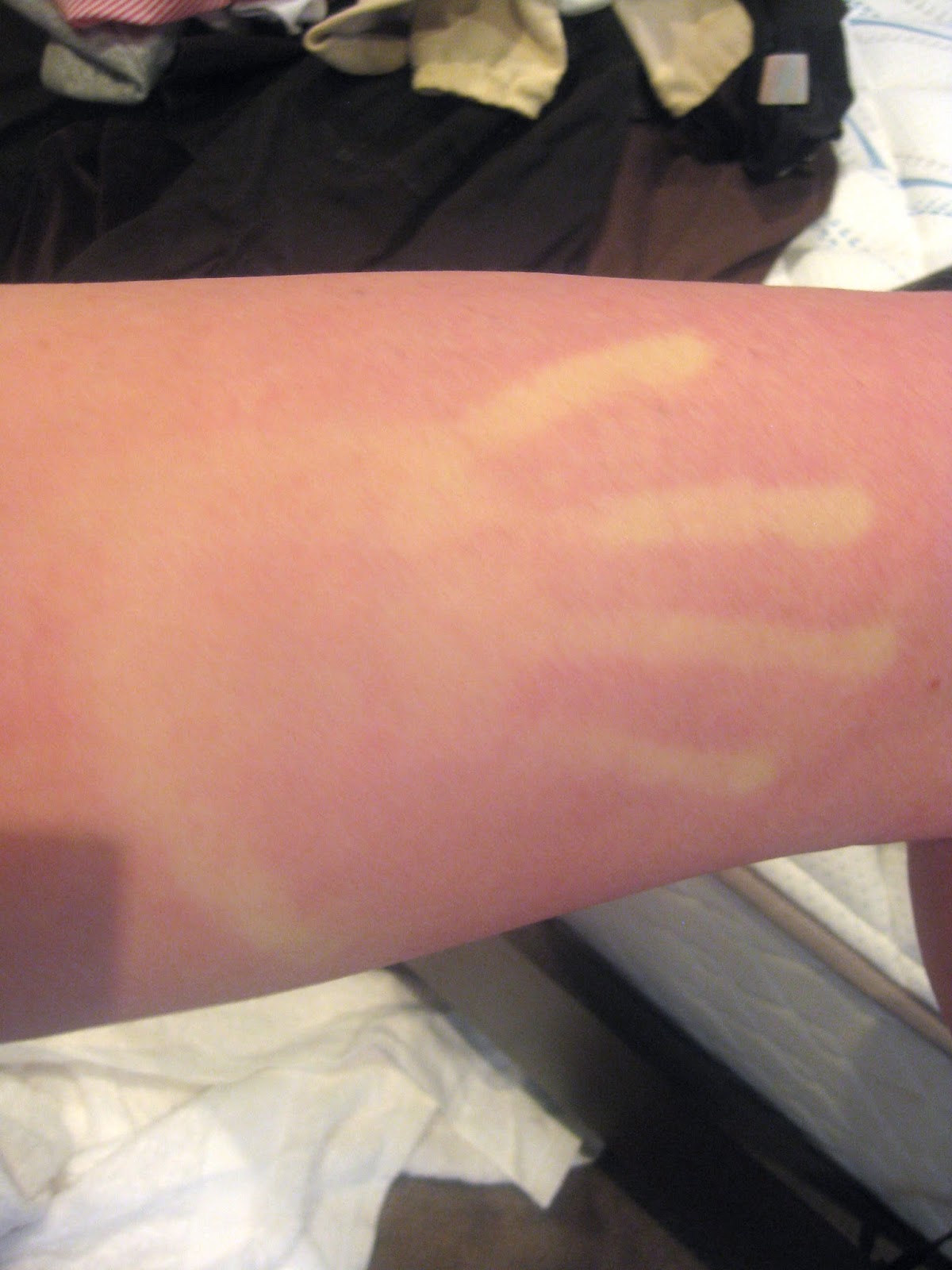 Topical Steroid Withdrawal Journey-Healing Eczema and Red Skin Syndrome ...