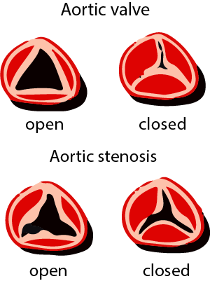 La sténose aortique