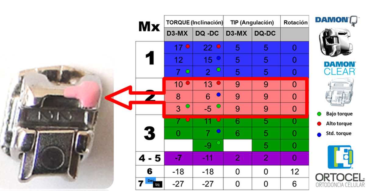 ORTOCEL: Tabla de prescripción de los brackets DAMON.