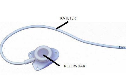 VENOUS PORT KATETERİ YERLEŞTİRME PROSEDURU VE KOPLİKASYONLAR