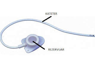VENOUS PORT KATETERİ YERLEŞTİRME PROSEDURU VE KOPLİKASYONLAR
