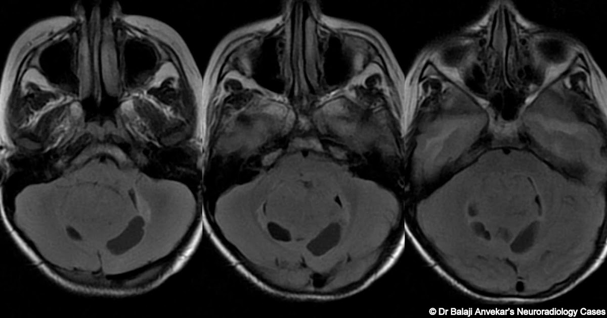 Medulloblastoma Mri