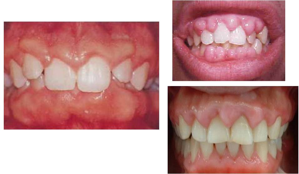 Be fabulous, Be healthy: La salud de nuestras encías ¿Cómo detectar ...