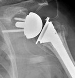 Shoulder Arthritis / Joint Replacement : Reverse total shoulder ...