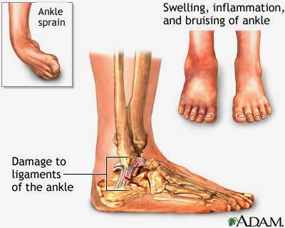 PENGERTIAN, CIRI DAN PENYEBAB CIDERA ANKLE