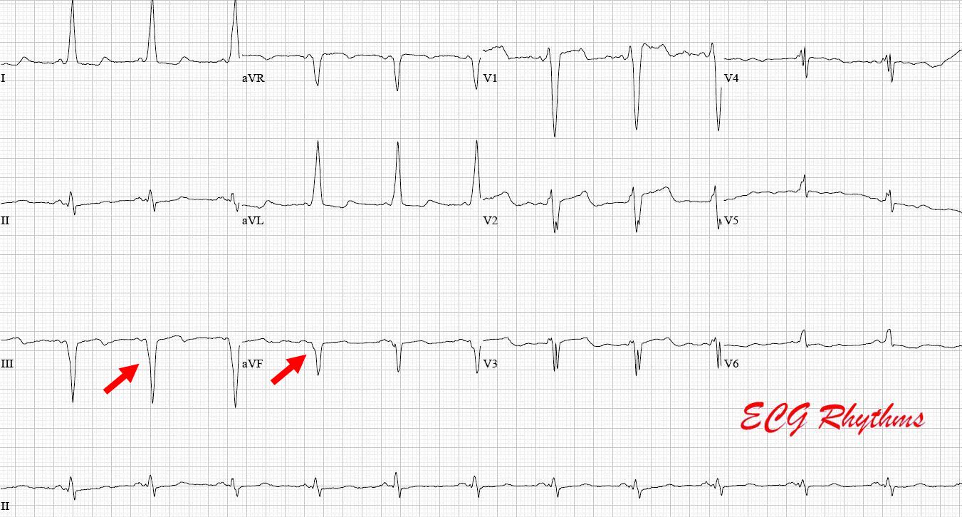 ECG Rhythms: Wolff-Parkinson-White pattern