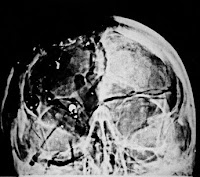 Grassy Knoll Institute: Who Stole President Kennedys Brain