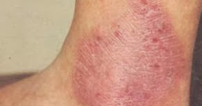 Cara Mengobati Penyakit Dermatitis Numularis Dengan Minyak Obat Mas ...