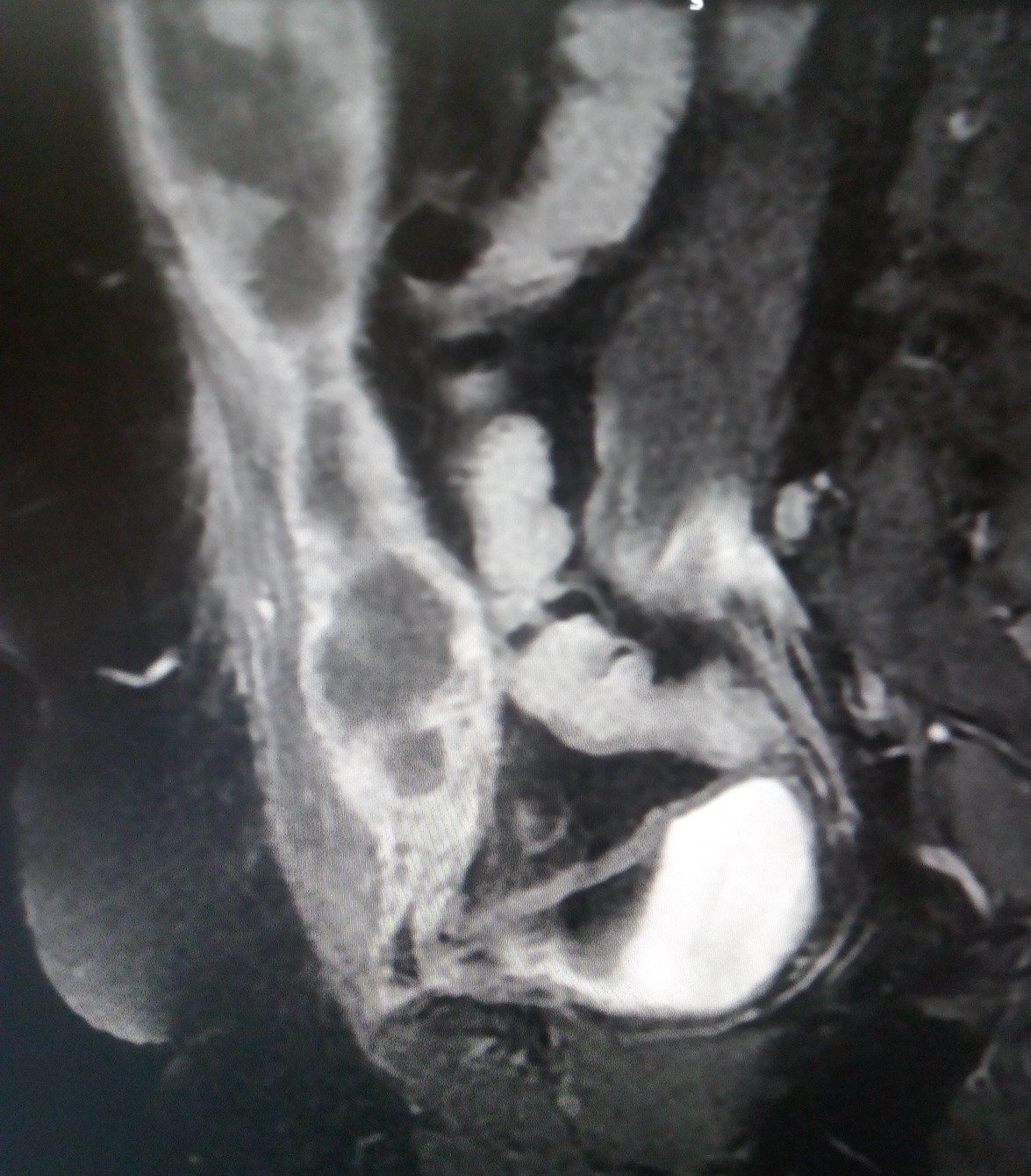 Abdominal wall mass –MRI Approach - Sumer's Radiology Blog
