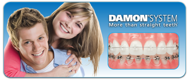DAMON System Braces by: DSB DENTAL CLINIC: Are Damon braces really better than regular braces?