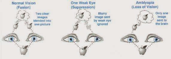 Clínica Optométrica 1 (IUO): OBJETIVO-7 PROCESOS DE FUSIÓN Y ESTEREOPSIS