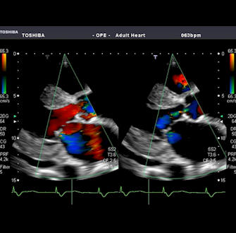 What is Cardiac Ultrasound and How is it Used?
