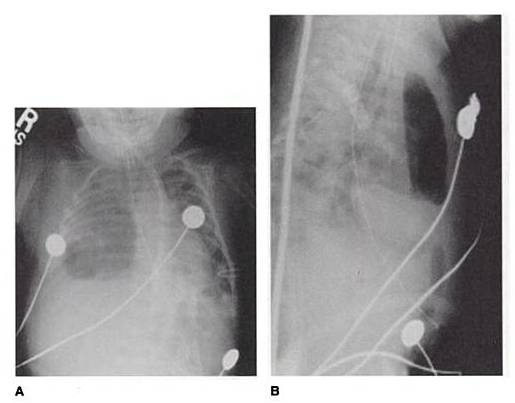 BEDAH UMUM FKUI: Pneumotoraks spontan pada neonatus