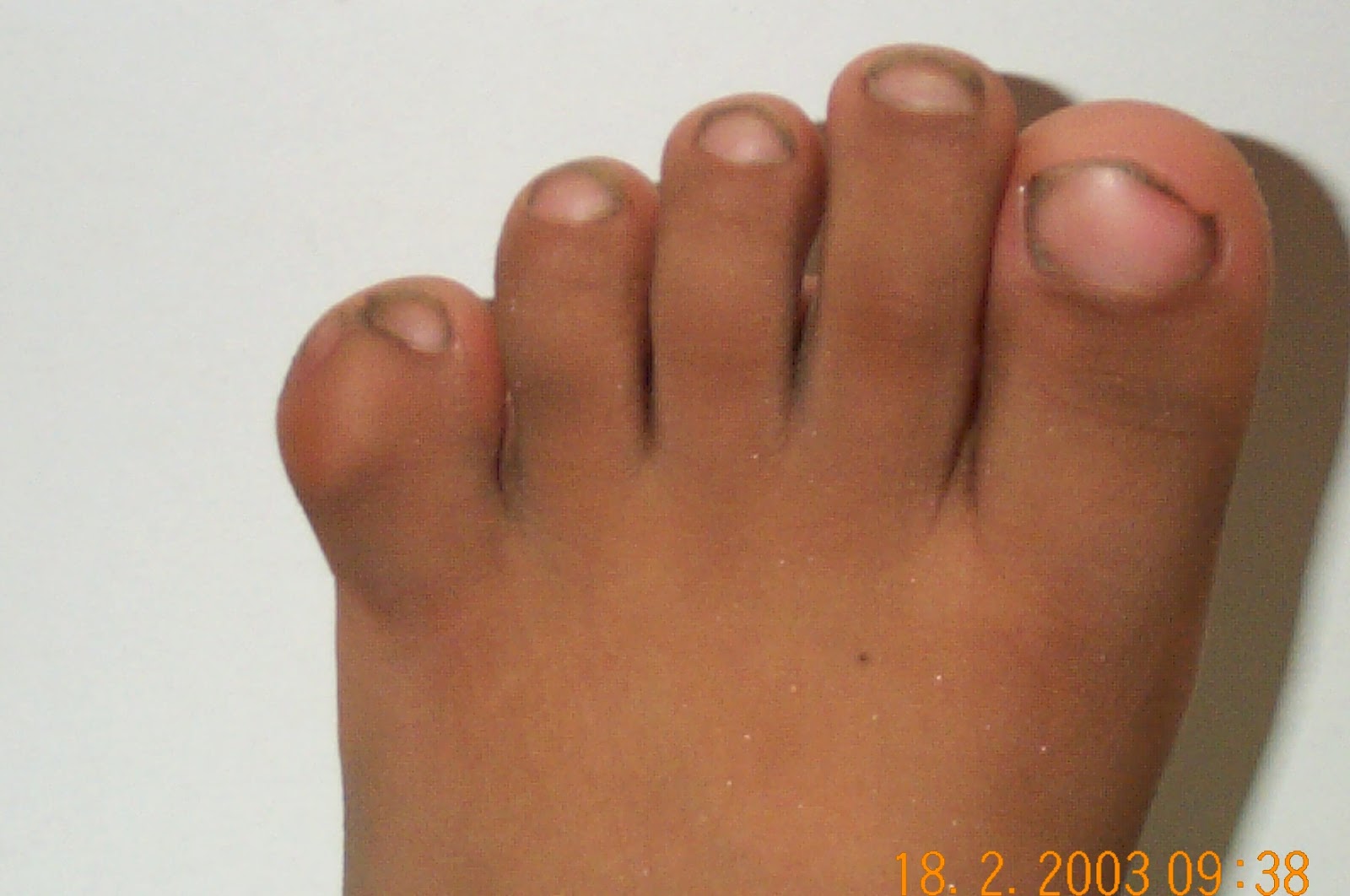 CIRUJANO DE PIE Y TOBILLO: POLIDACTILIA