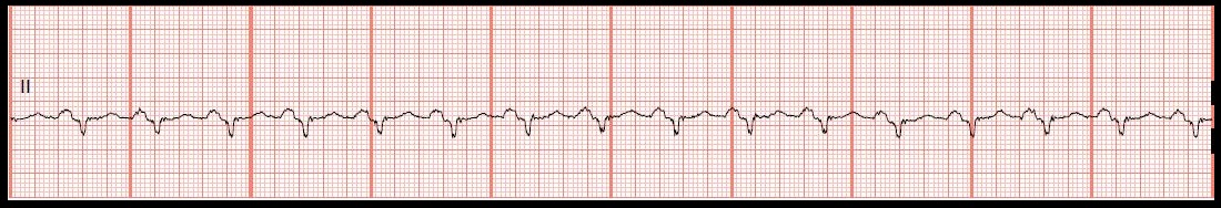 Practice EKG Rhythm Strips 139