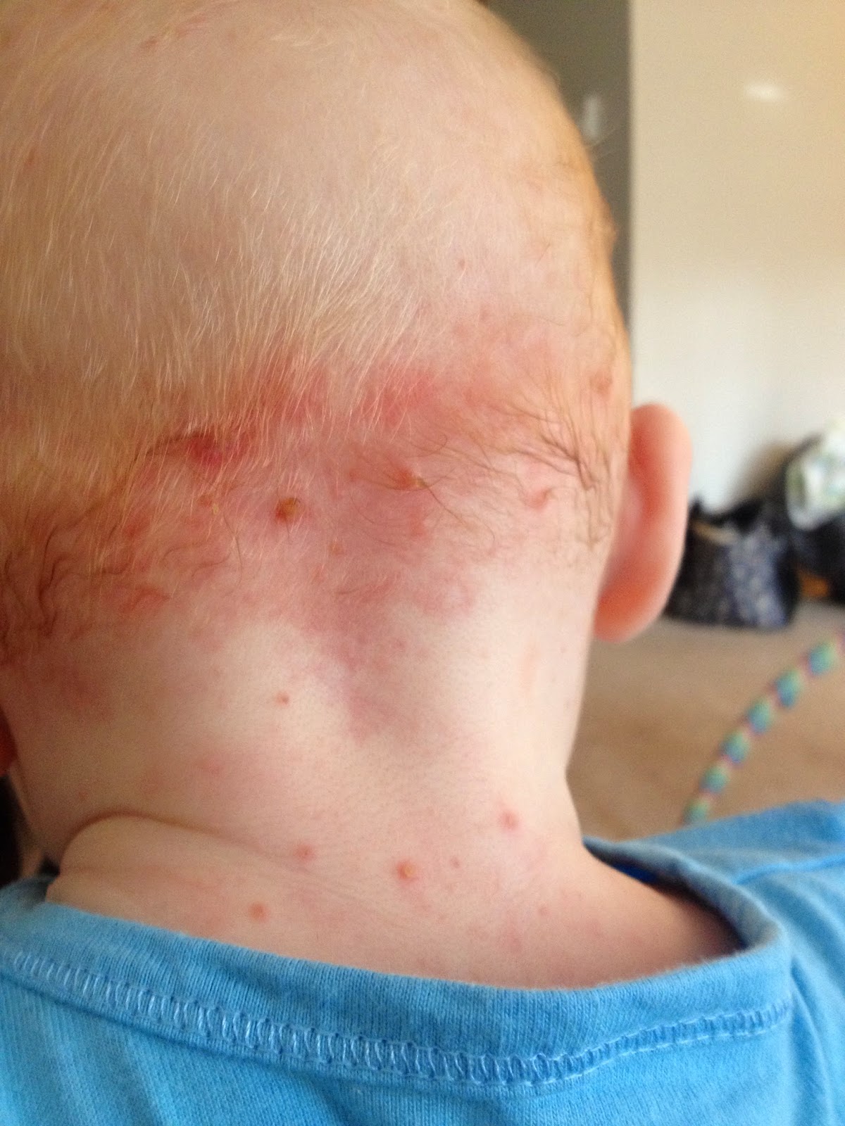 SammyAnne & Bran: Oliver and Langerhans Cell Histiocytosis