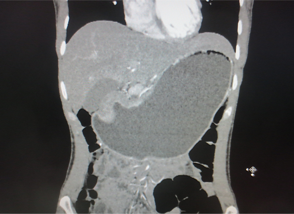 VIETNAMESE MEDIC ULTRASOUND: CASE 171: THICKENING OF ANTRUM WALL, Dr ...