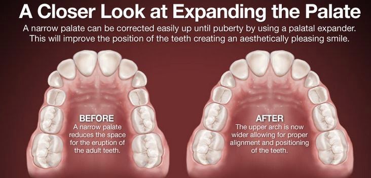 Poser Orthodontics Blog: Palatal Expander