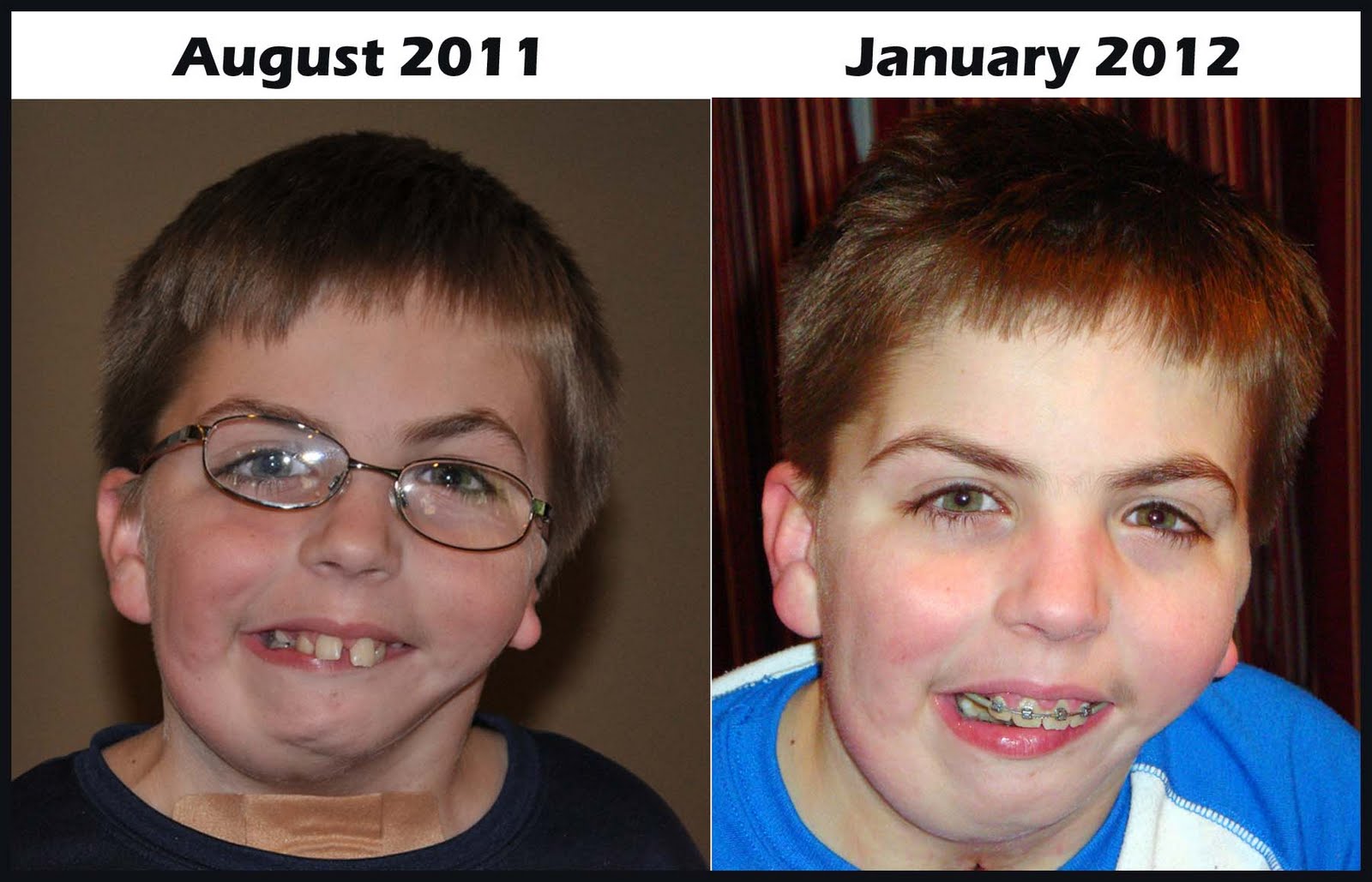 Before And After Braces: Before And After Braces Side Profile