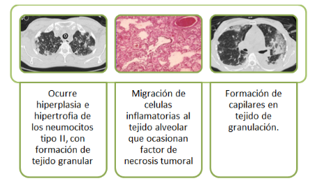 SÍNDROME DE DISTRÉS RESPIRATORIO AGUDO : Fases de SDRA