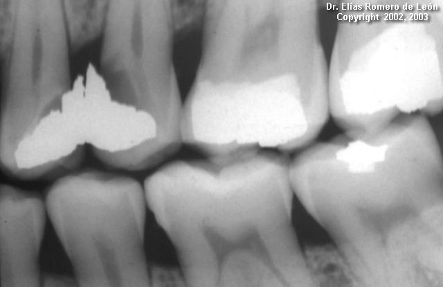 Integral 2012 Dra Cerda: Caries Recidivante