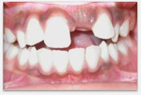 Asnan pro: Delayed Eruption of Teeth