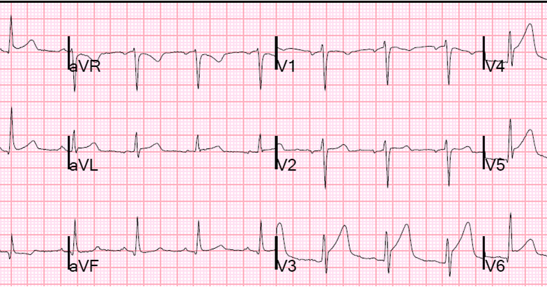 Dr. Smith's ECG Blog: Gunshot wound to the chest with ST Elevation