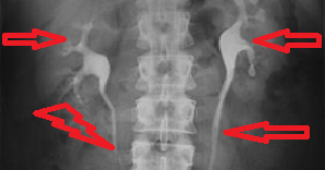 Teknik Radiografi: Teknik Radiografi IVP