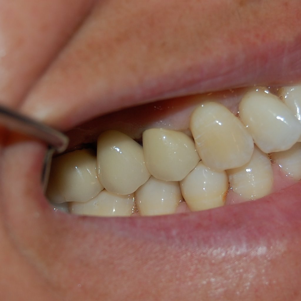 DR DEDIU: Ce sunt dintii de portelan?