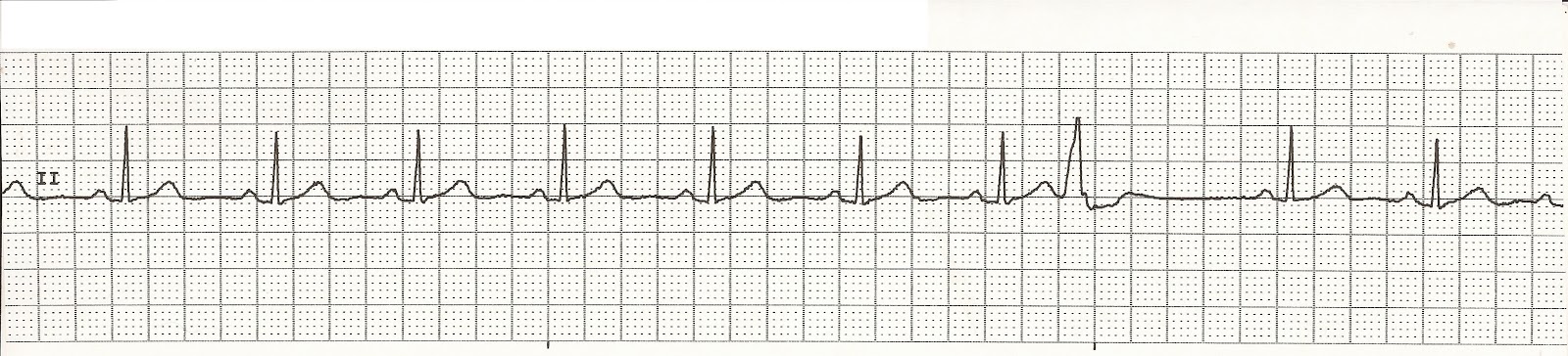 EKG Rhythm Strips 72