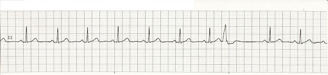 EKG Rhythm Strips 72