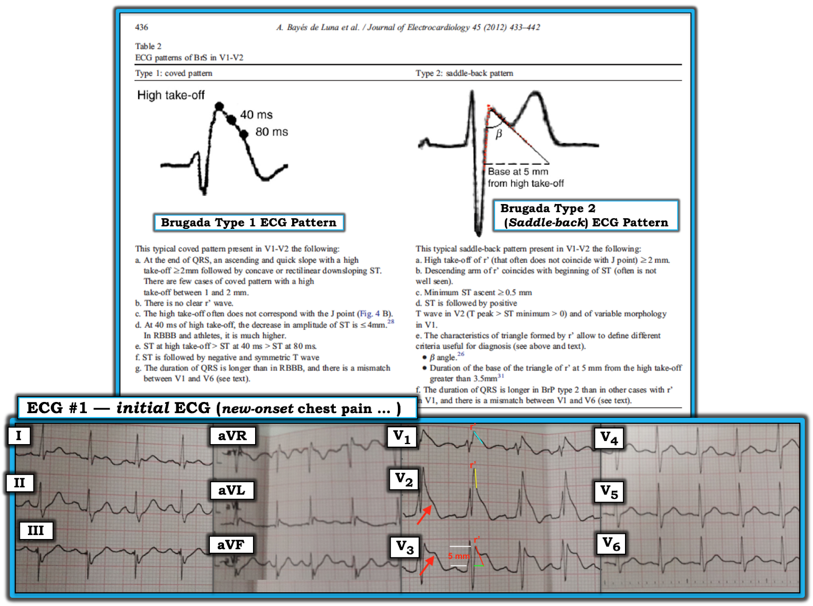 Dr. Smith's ECG Blog: A Middle-Aged male with Chest Pain and an Unusual ECG